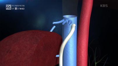 변형 우엽 생체 간 이식이 세계 표준 수술법이 되기까지 | KBS 220105 방송 | 네이트 TV